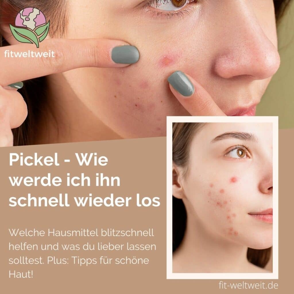 Pickel schnell loswerden: Hilfreiche SOS Tipps gegen Pickel!